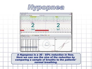 Flow volume loop quick loop guide | PPT