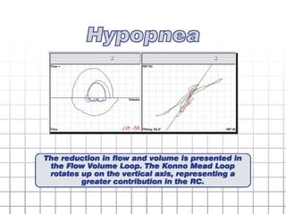 Flow volume loop quick loop guide | PPT