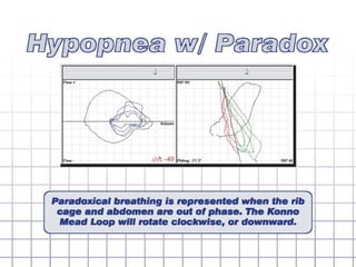 Flow volume loop quick loop guide | PPT