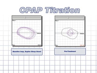 Flow volume loop quick loop guide | PPT