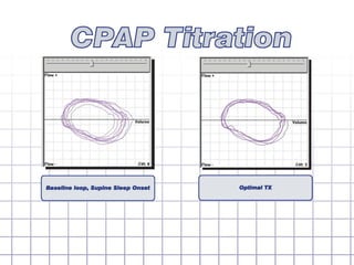Flow volume loop quick loop guide | PPT