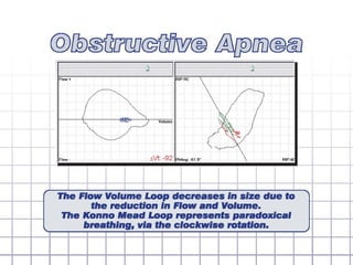 Flow volume loop quick loop guide | PPT