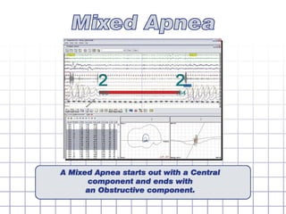 Flow volume loop quick loop guide | PPT