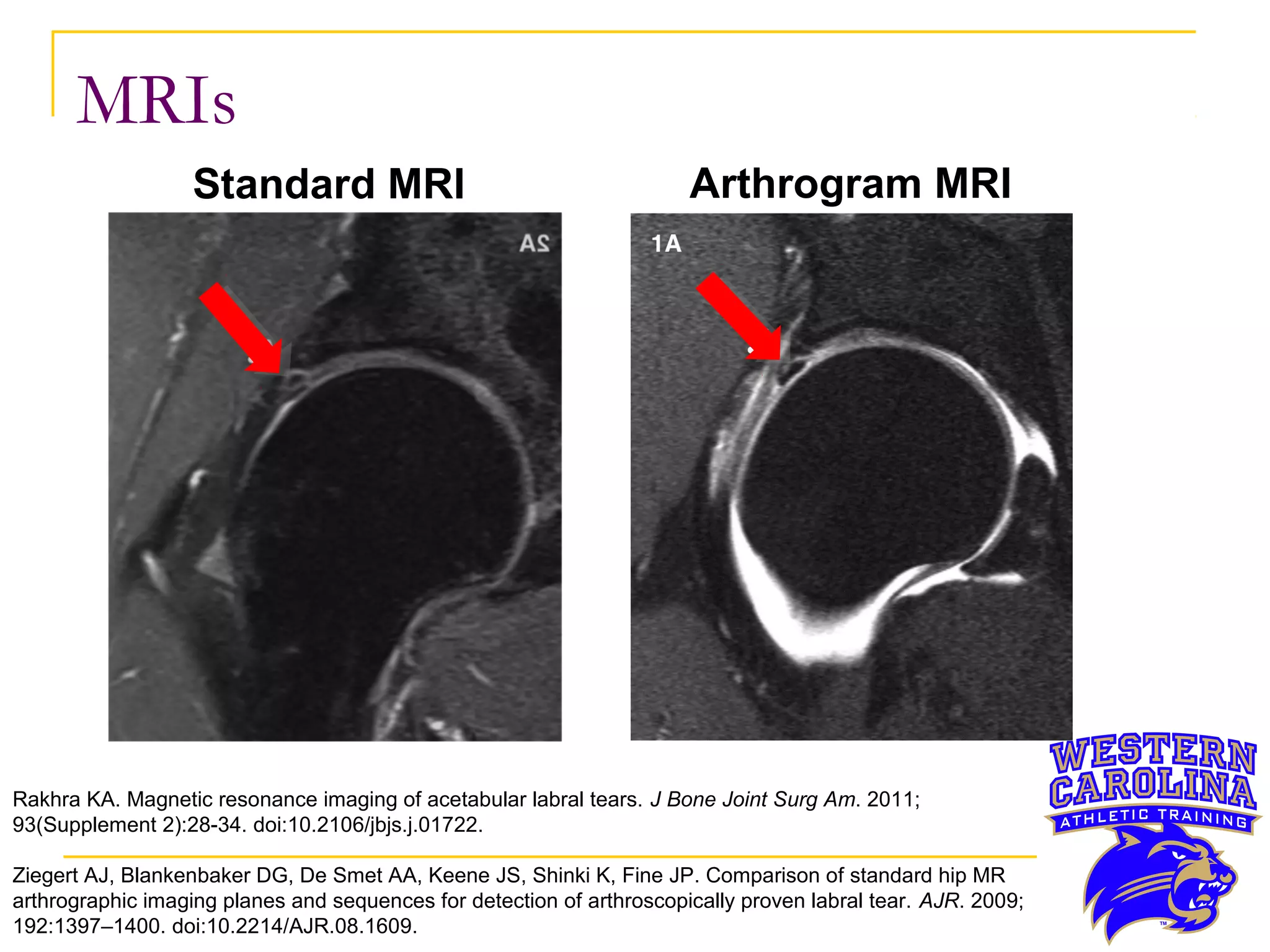 Right Hip Labral Tear in a 22 Year-Old Collegiate Male | PPT