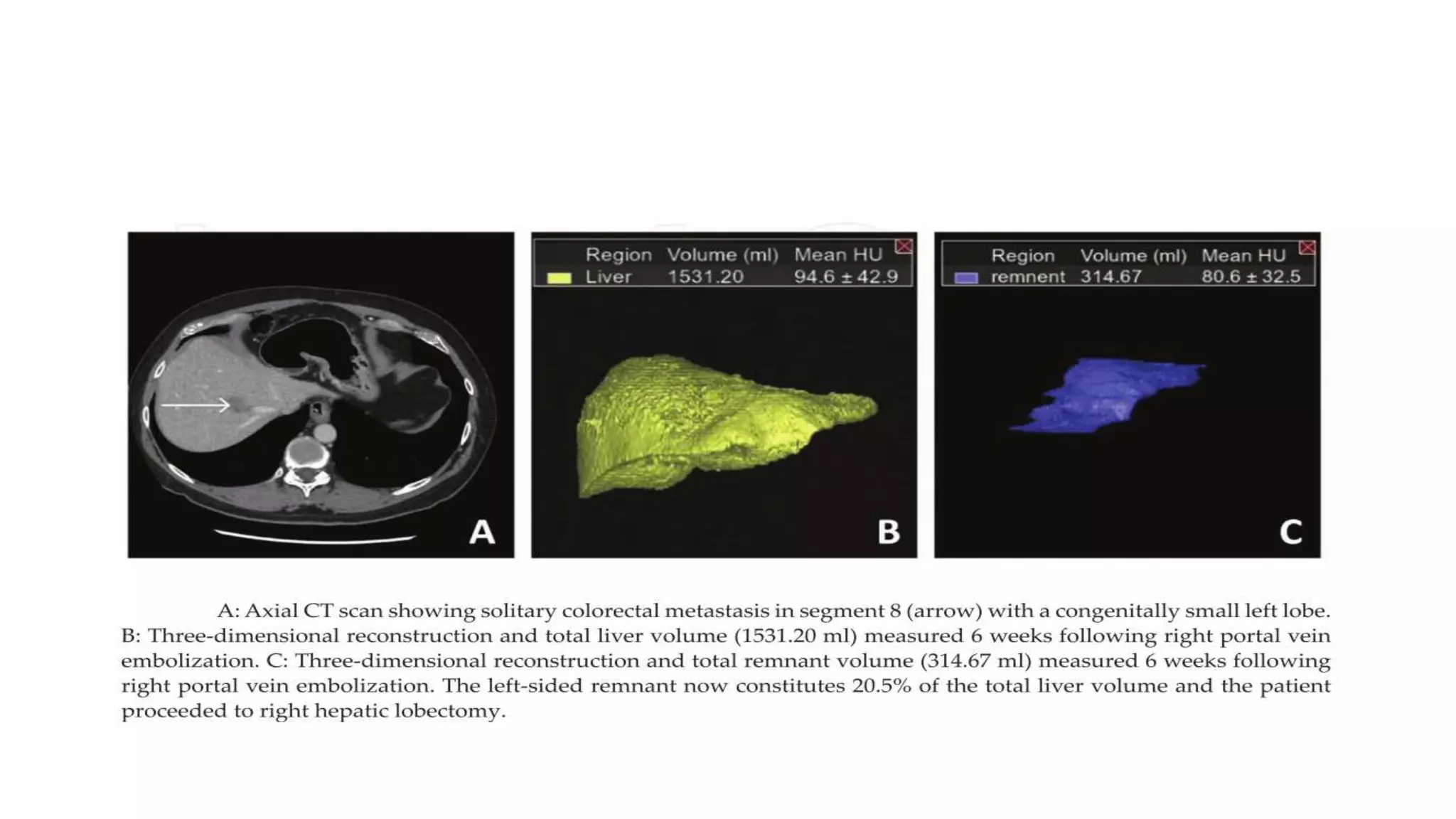 Functional liver residue-- All we need to know | PPTX