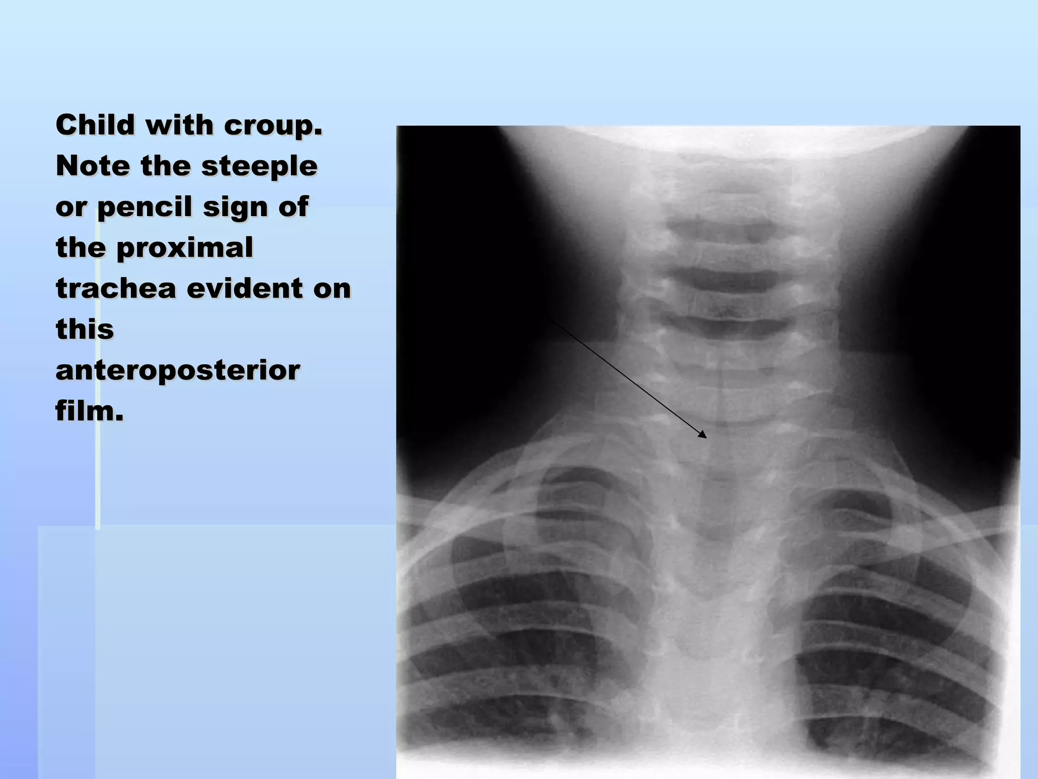 Influenza | PPT