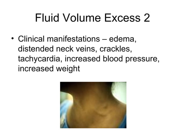 Fluid and electrolytes, balance and disturbances (1) | PPT