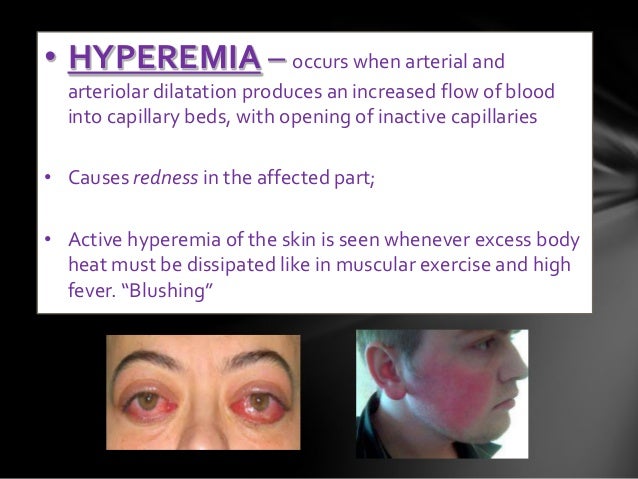 Fluid and Hemodynamic Derrangements