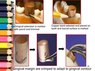 Fluid control and gingival displacement | PPTX