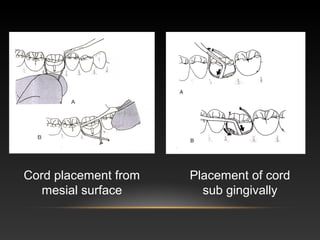 Fluid control and Soft tissue management | PPT