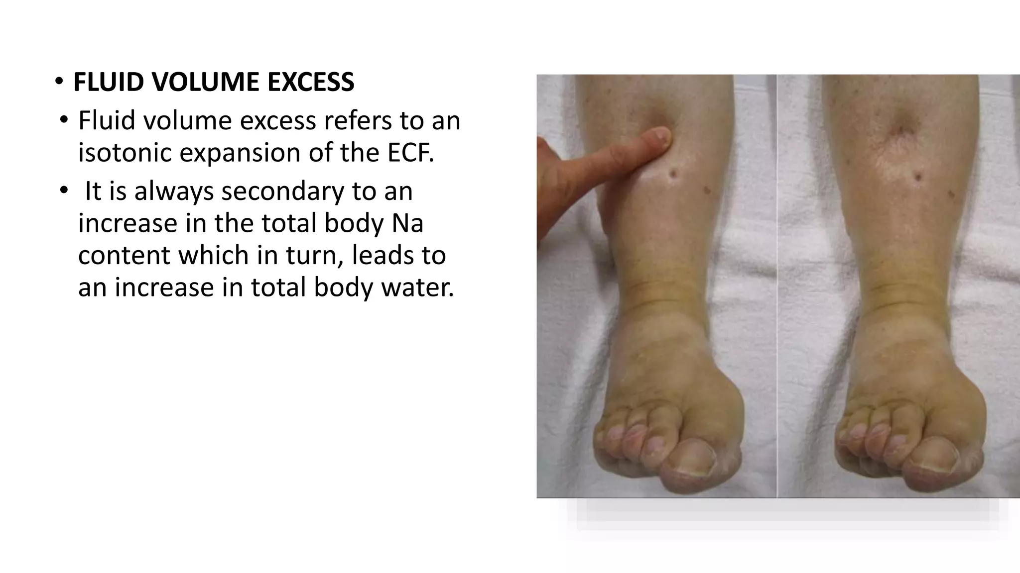 fluid & electrolyte imbalance.pptx