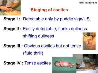 Fluid in abdomen | PPT
