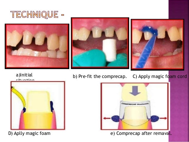 Fluid management & Gingival Displacement