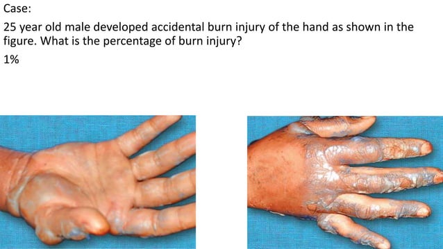 Fluid management in burns and shock | PPTX