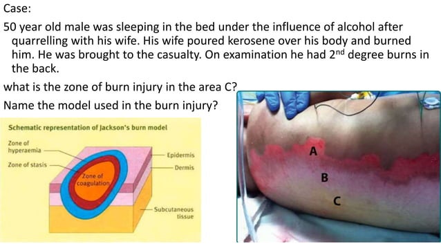 Fluid management in burns and shock | PPTX