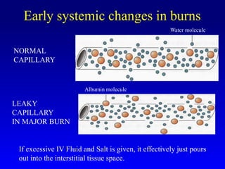 Burn Fluid Resuscitation Key Issuespptx.pptx