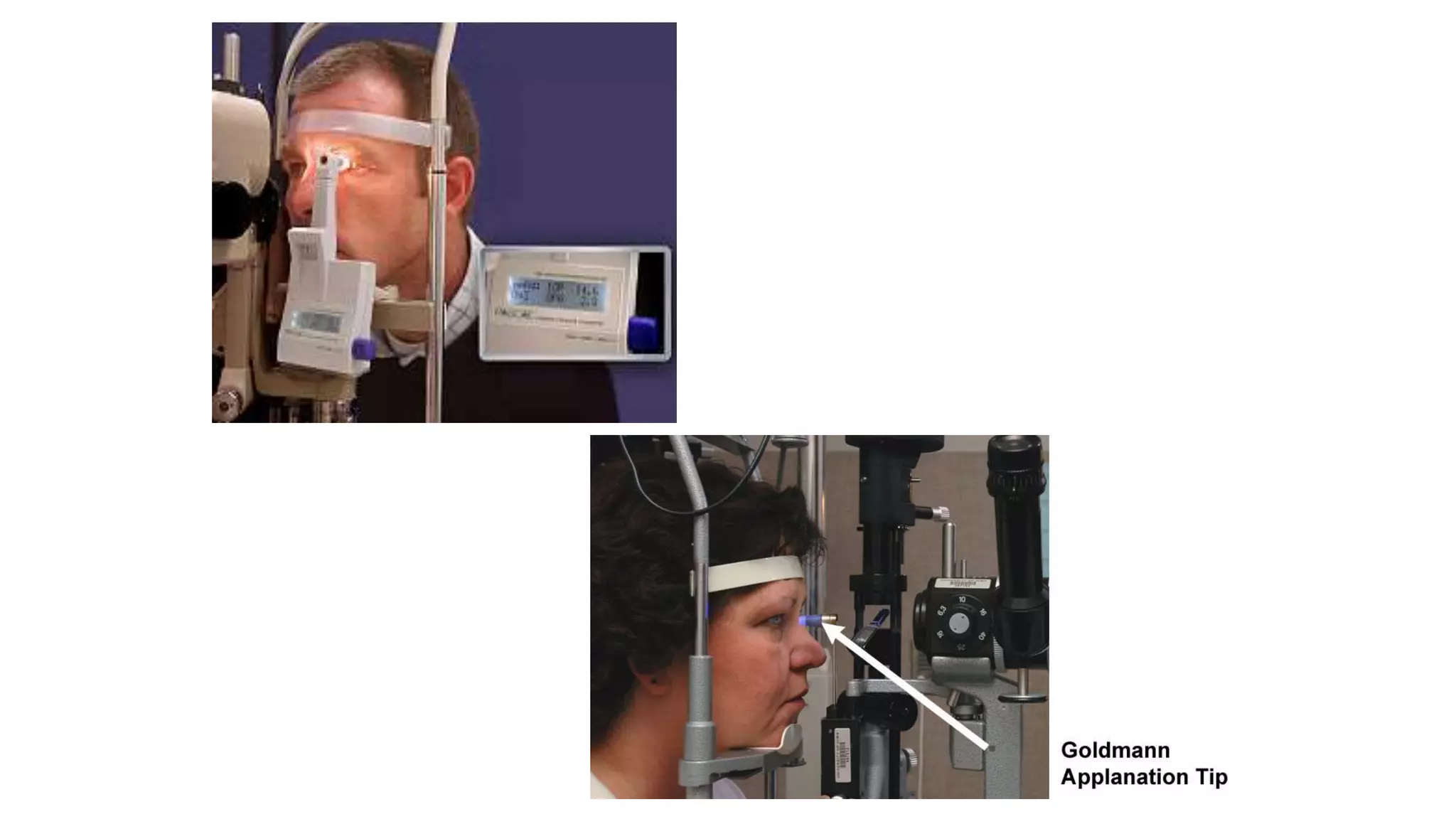 Fluid system of the eye (Glaucoma) | PPTX
