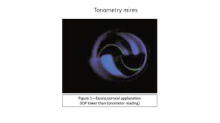 Fluid system of the eye (Glaucoma) | PPTX