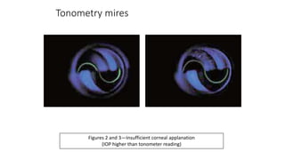 Fluid system of the eye (Glaucoma) | PPTX