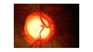 Fluid system of the eye (Glaucoma) | PPTX