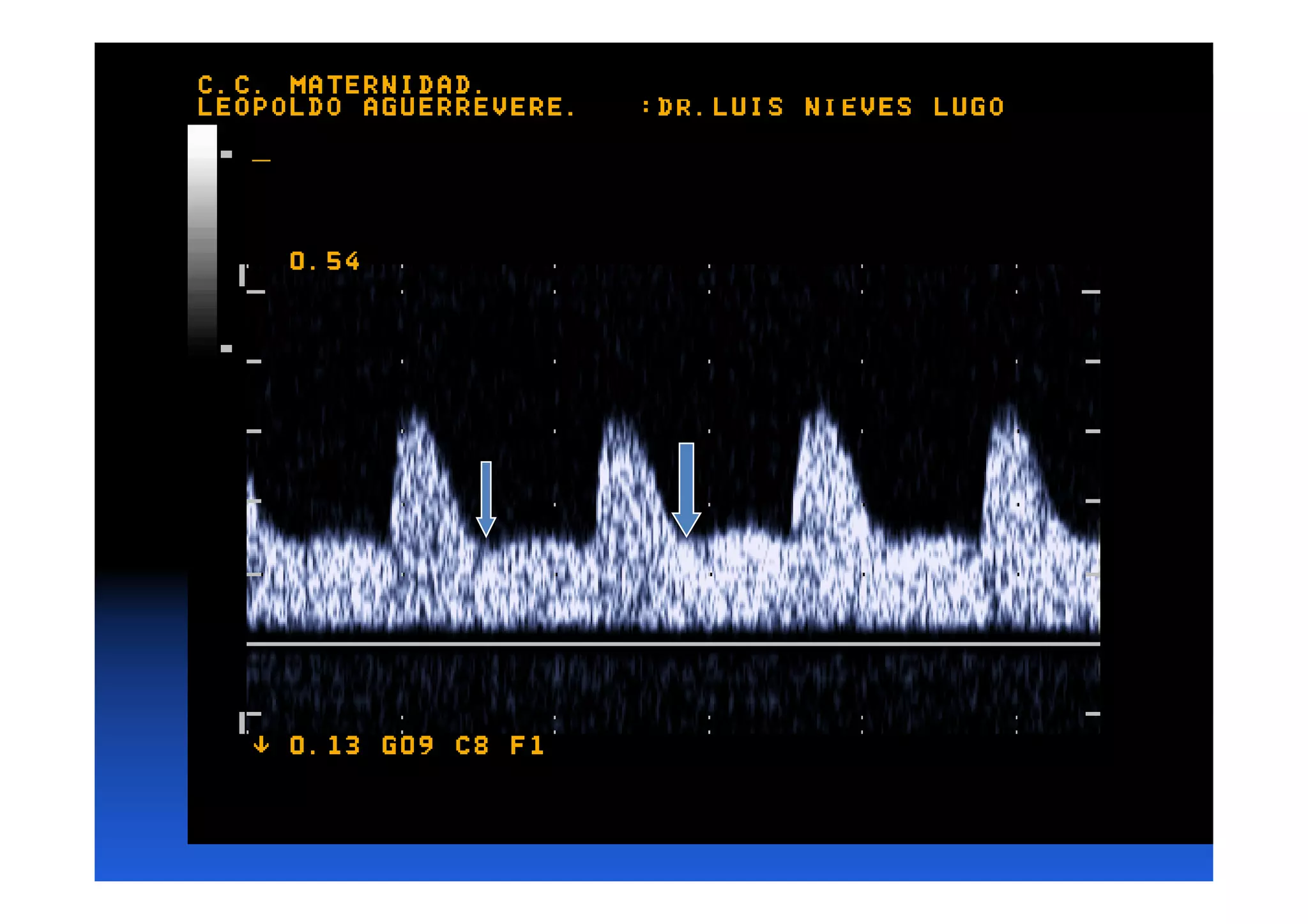 Flujometria doppler | PDF | Pregnancy | Reproductive Health