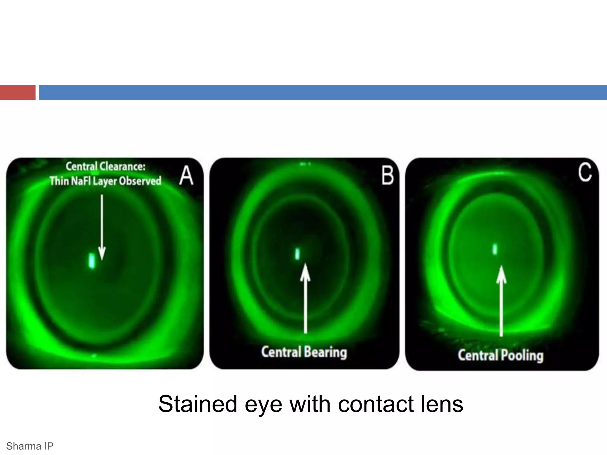 Fluorescein Stain | PPTX