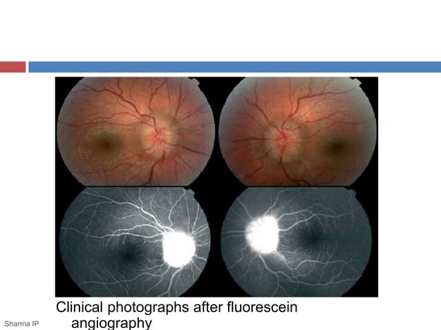 Fluorescein Stain | PPTX | Eye and Vision Conditions | Diseases and ...