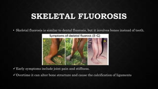 FLUORIDE.pptx