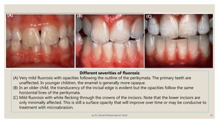 Fluoride and dental health | PPTX