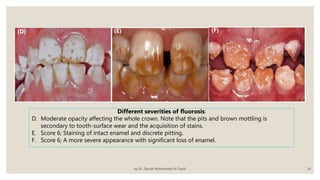 Fluoride and dental health | PPTX