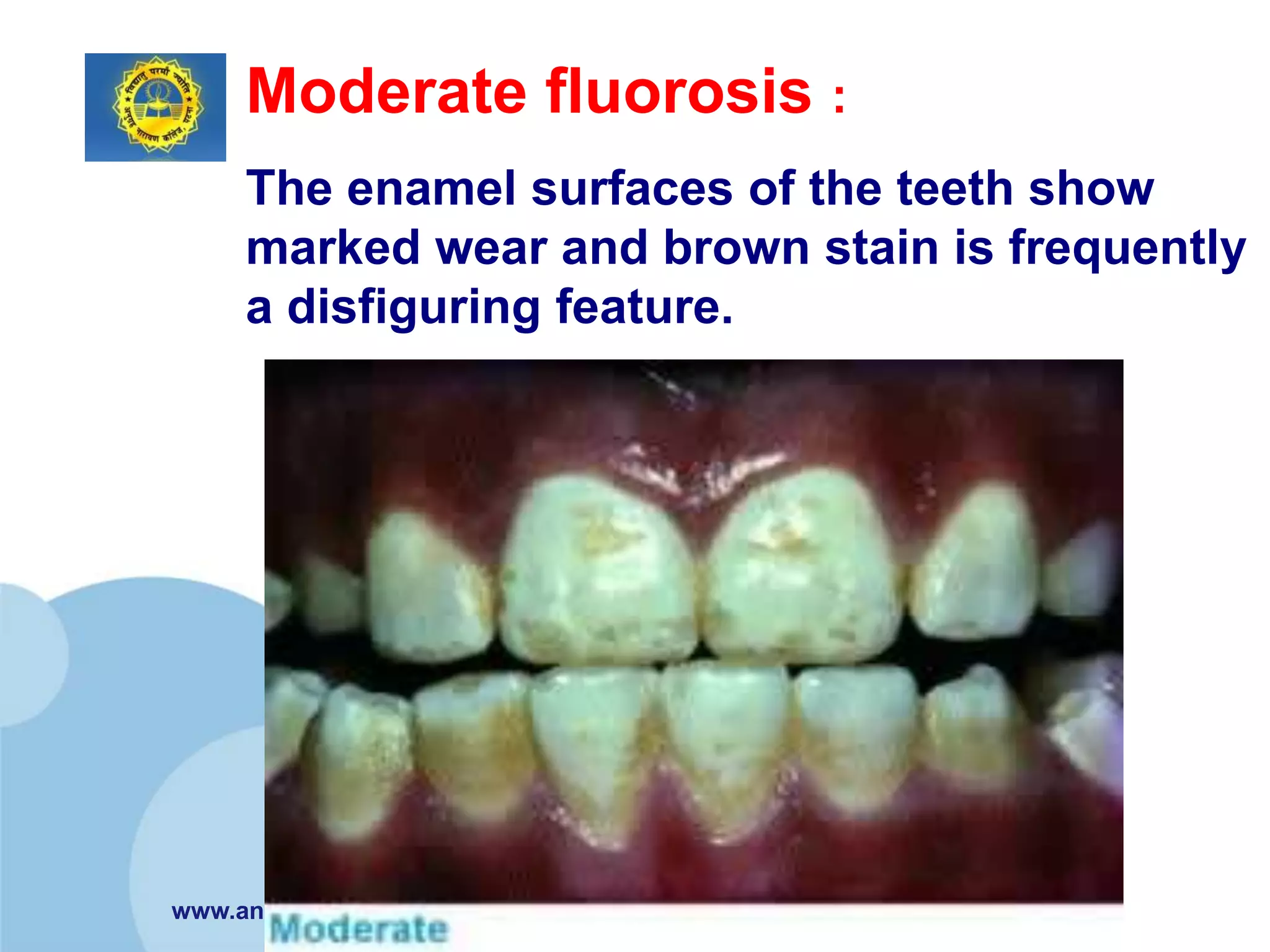 Fluoride contamination in ground water | PPTX