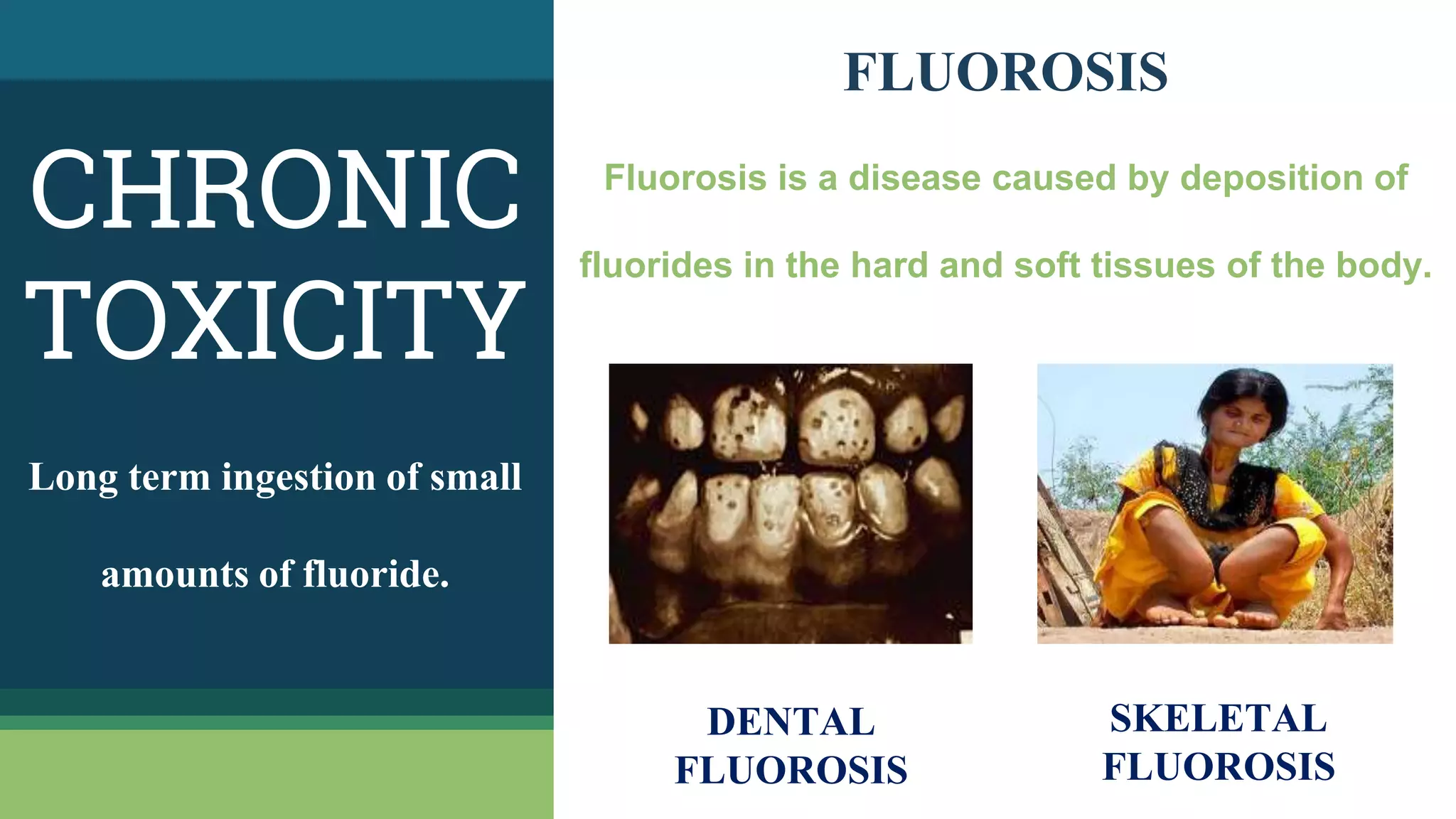 Fluoride toxicity | PPTX