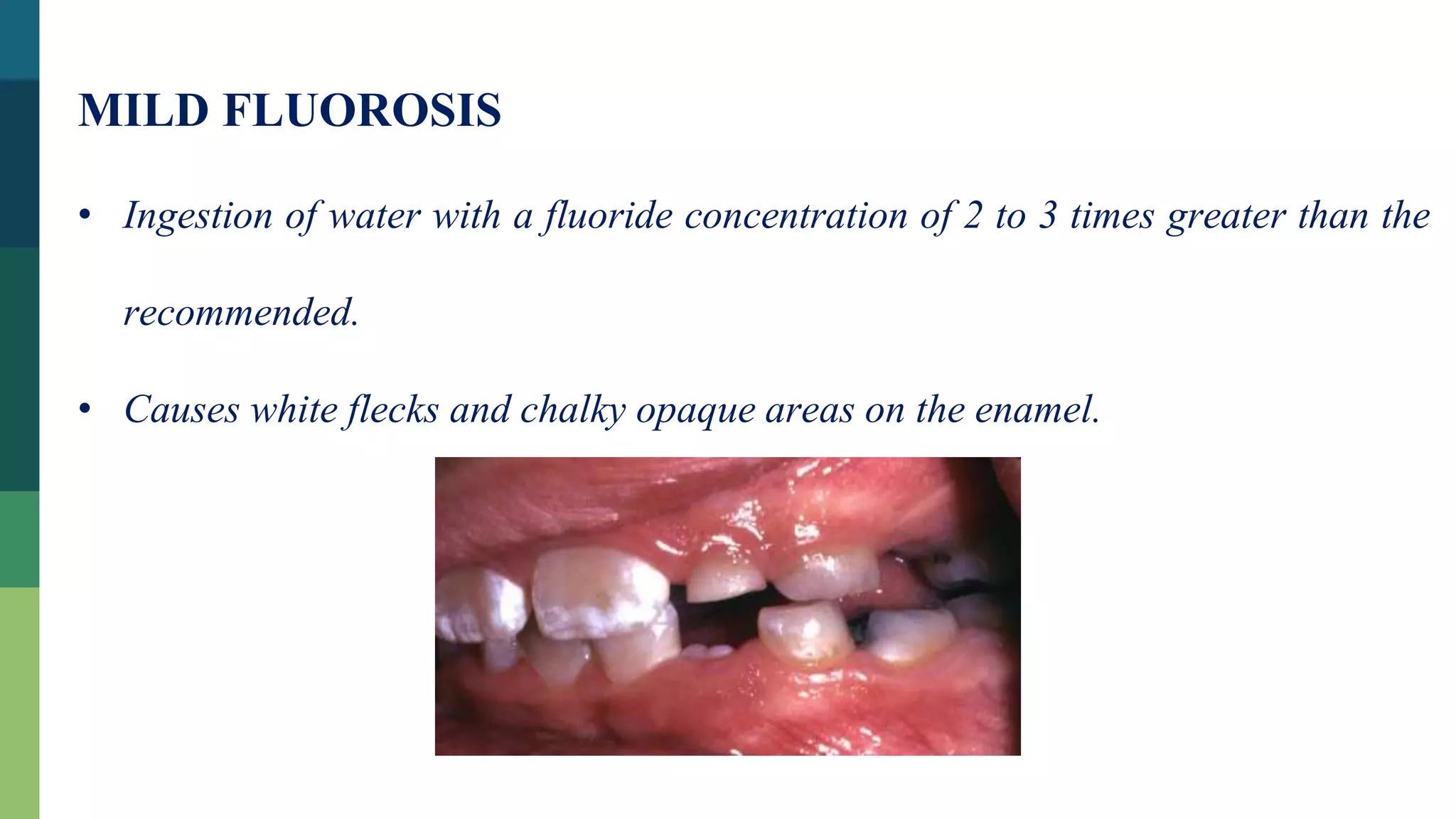 Fluoride toxicity | PPTX