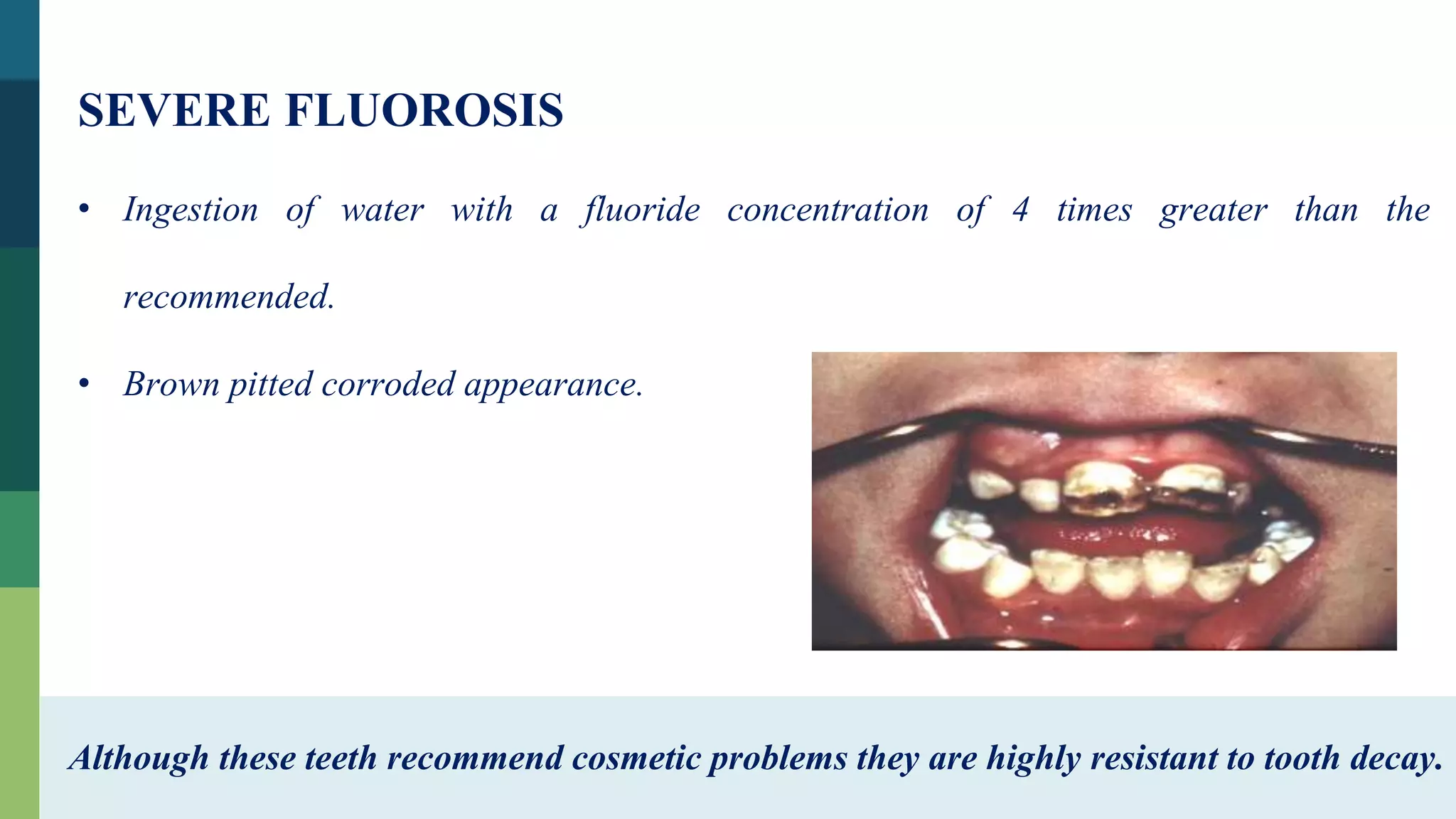 Fluoride toxicity | PPTX