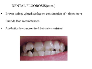 Fluoride toxicity | PPTX