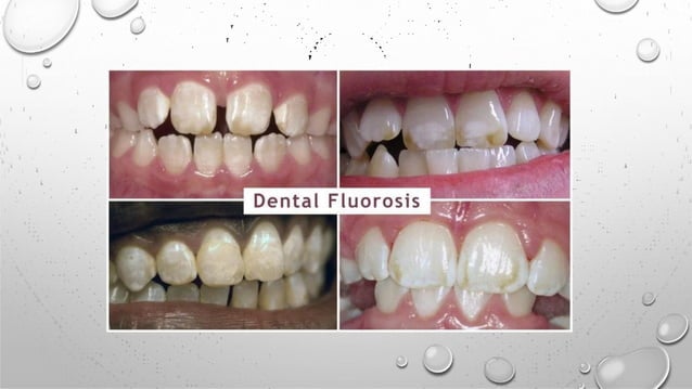 fluoride toxicity and methods of defluridation.pptx