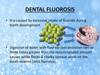 Acute and chronic Fluoride toxicity | PPTX
