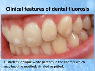 Acute and chronic Fluoride toxicity | PPTX
