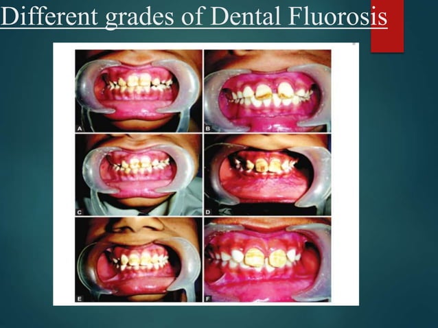 Fluoride toxicity - slideshare | PPTX | Dental Health | Diseases and ...
