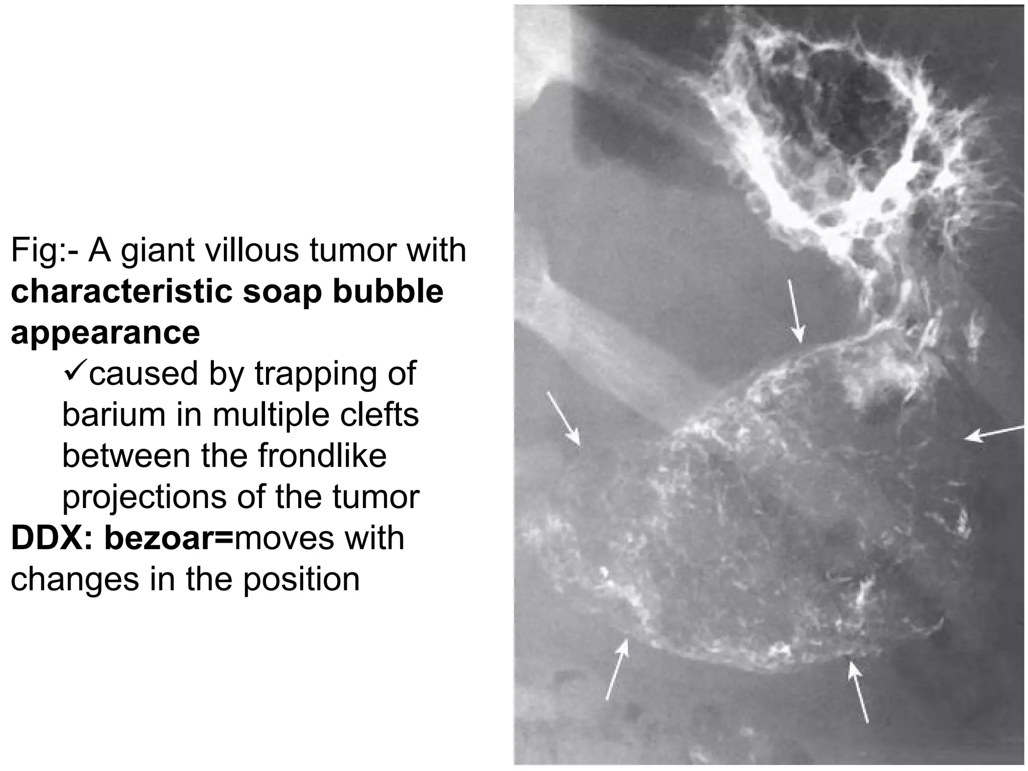 Fluoroscopic imaging anatomy and pathology of stomach and duodenum ...