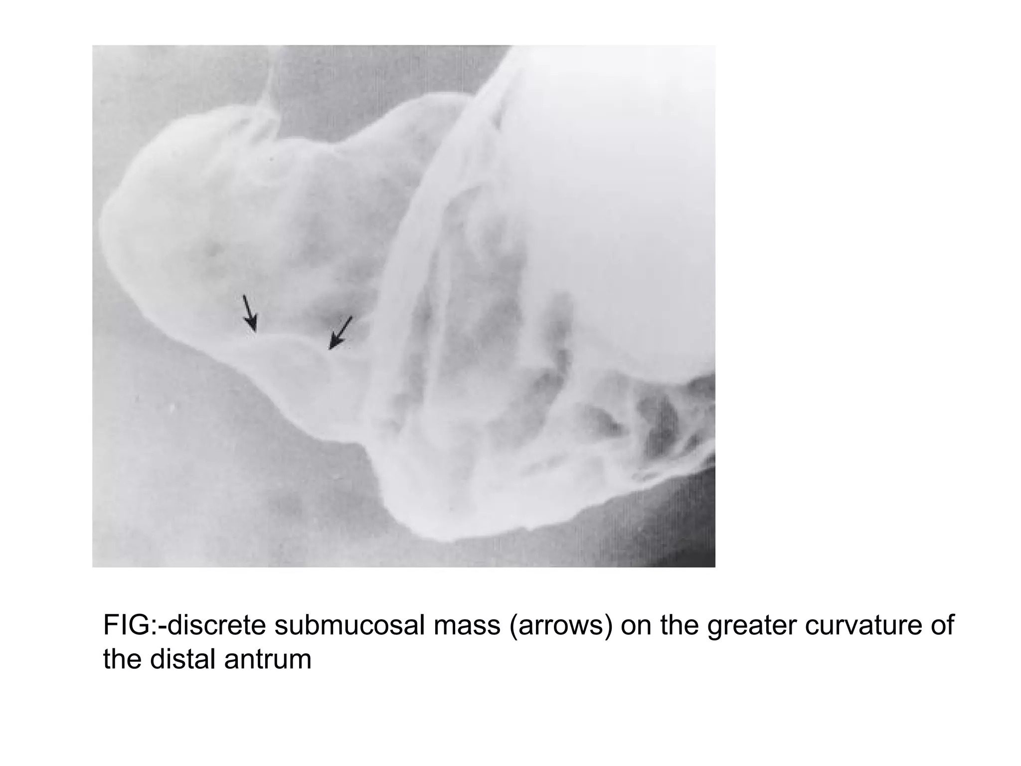 Fluoroscopic imaging anatomy and pathology of stomach and duodenum ...