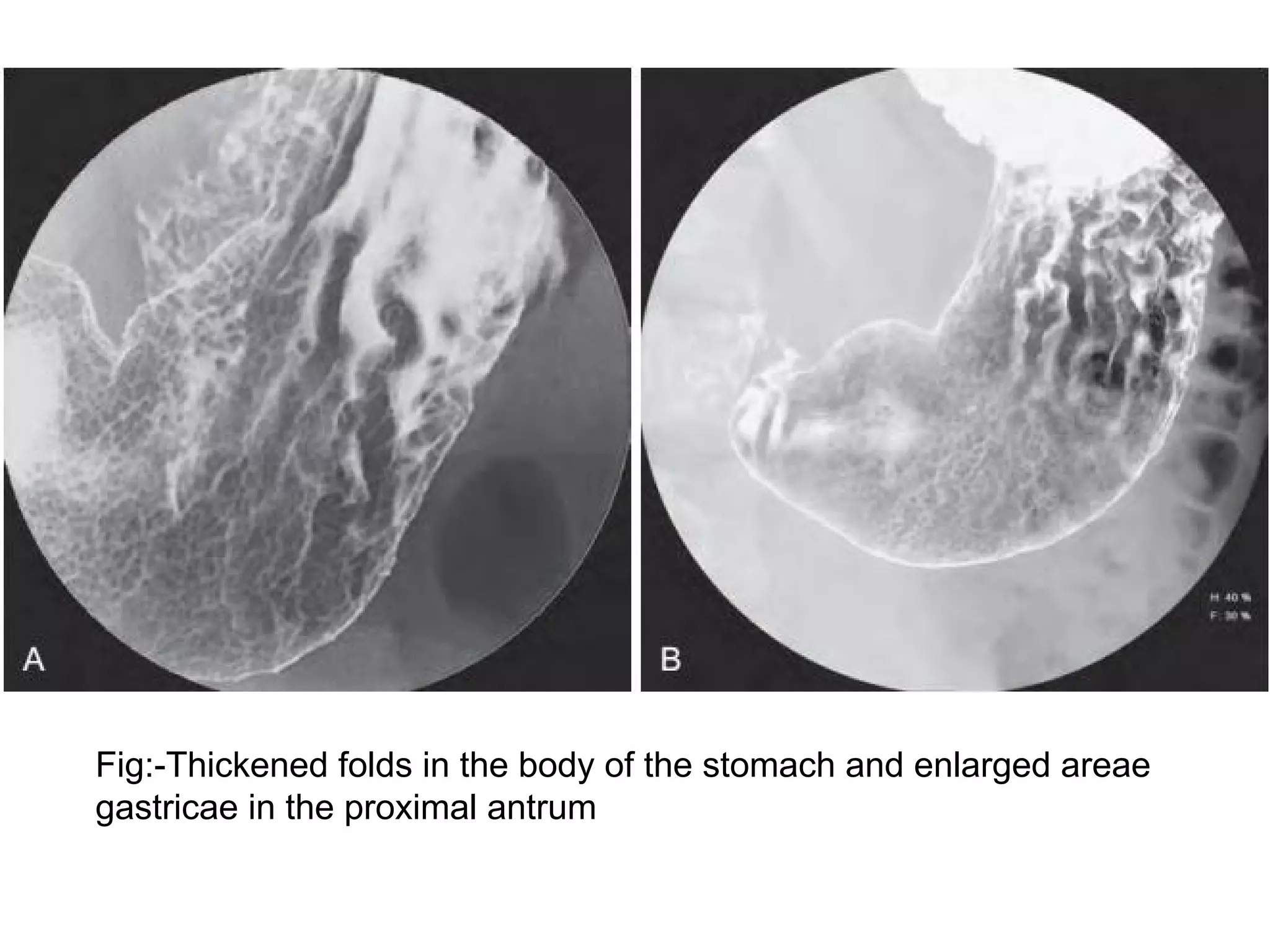 Fluoroscopic imaging anatomy and pathology of stomach and duodenum ...