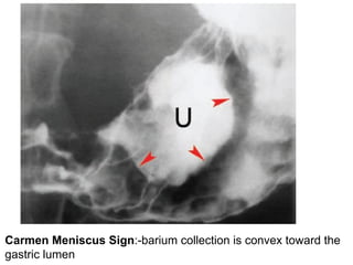 Fluoroscopic imaging anatomy and pathology of stomach and duodenum ...