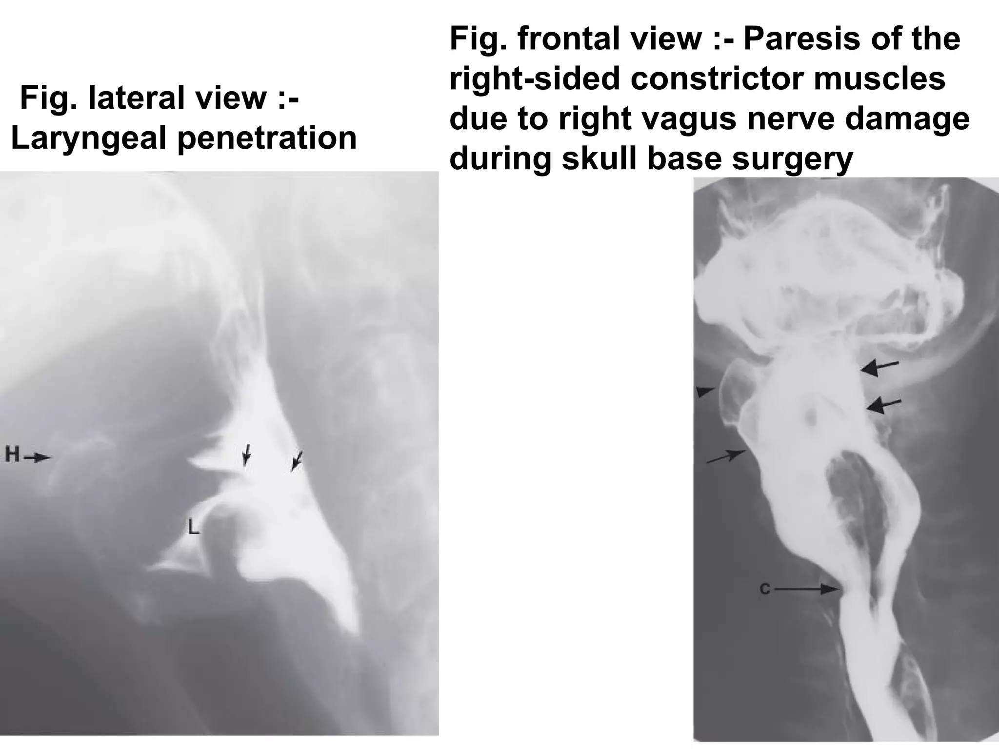 Fluoroscopic techniques and anatomy of pharynx and esophagus final | PDF