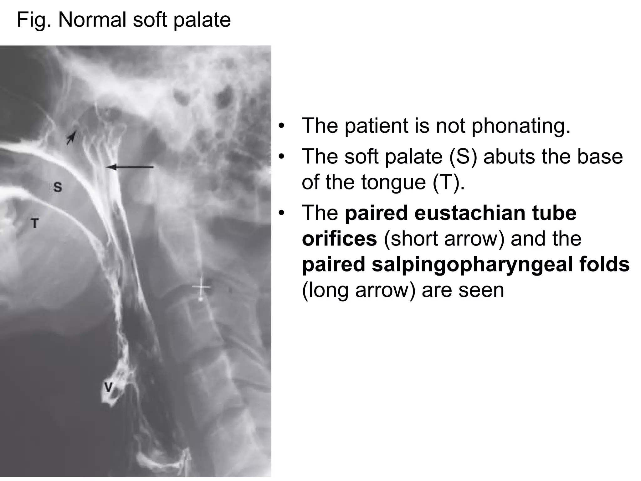 Fluoroscopic techniques and anatomy of pharynx and esophagus final | PDF