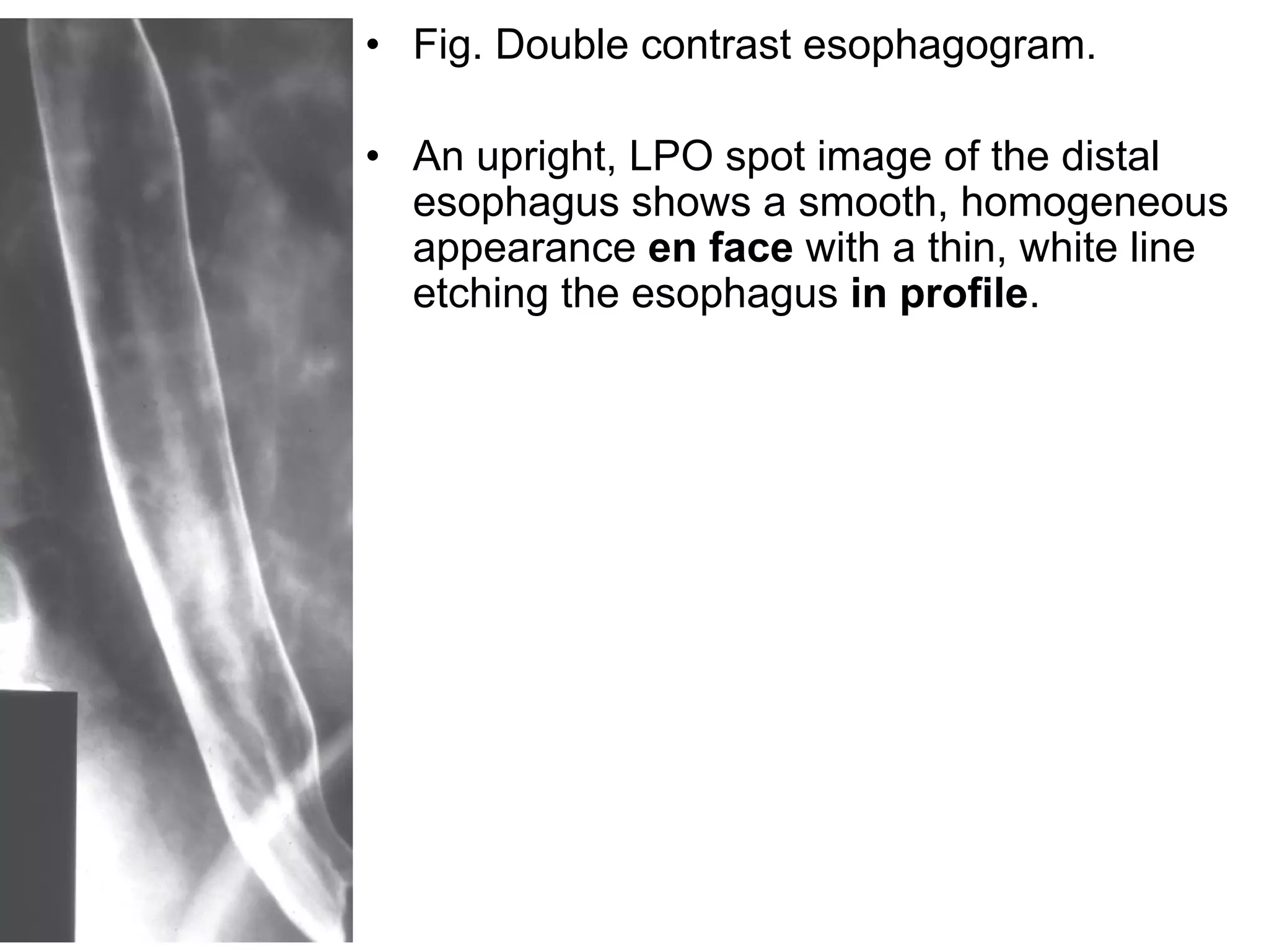 Fluoroscopic techniques and anatomy of pharynx and esophagus final | PDF