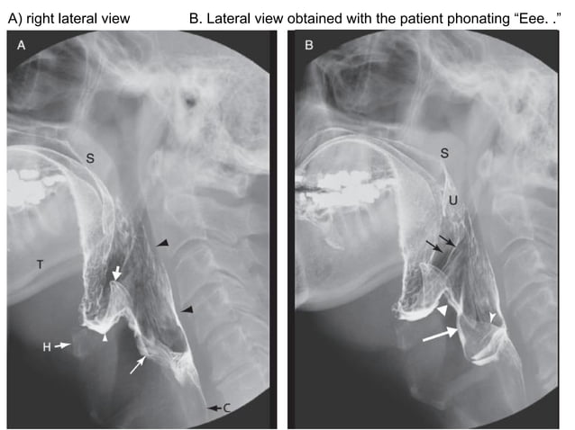 Fluoroscopic techniques and anatomy of pharynx and esophagus final