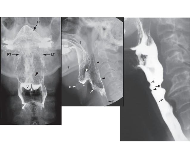 Fluoroscopic techniques and anatomy of pharynx and esophagus final