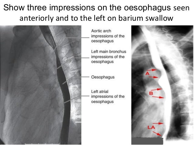 Fluoroscopic techniques and anatomy of pharynx and esophagus final