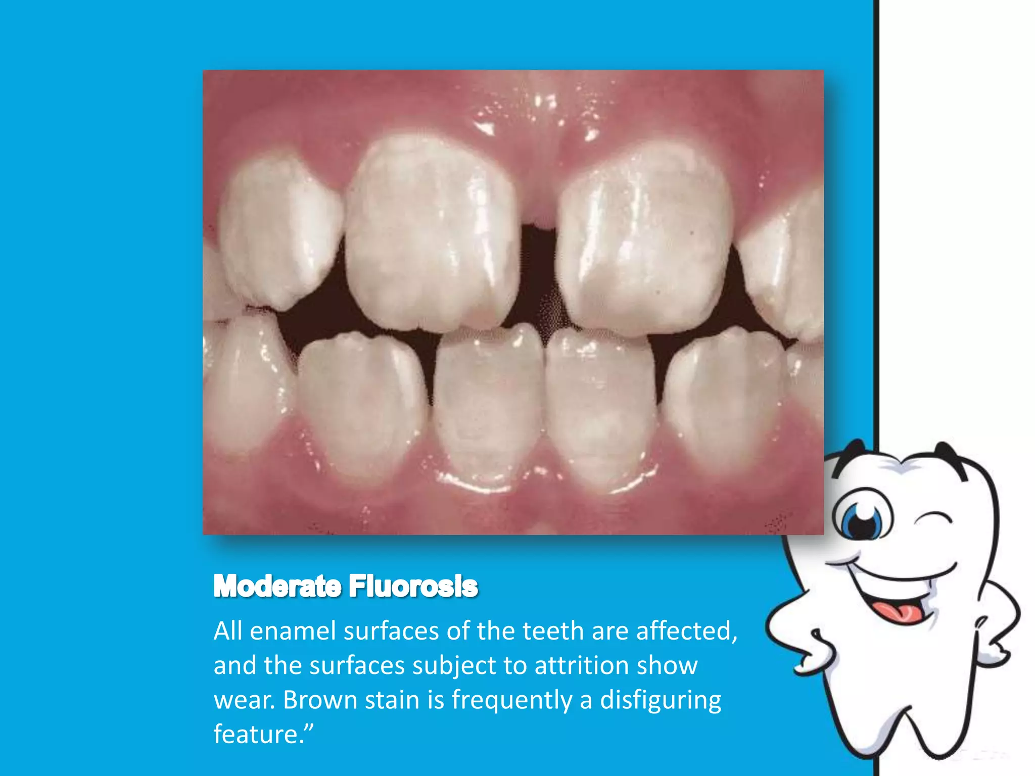 Dental Fluorosis | PPTX